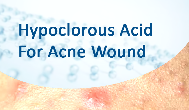Hypochlorous Acid for Acne Wounds: A Game-Changer in Skincare